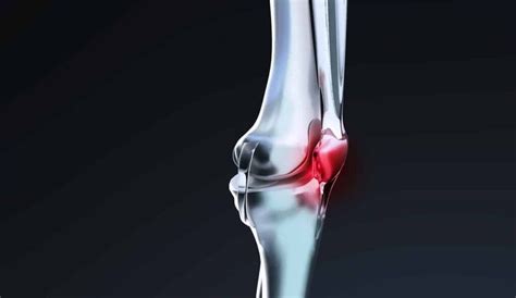 Polyarthralgie Inflammatoire Comprendre Et Gérer Les Douleurs Articulaires Multiples Atlas
