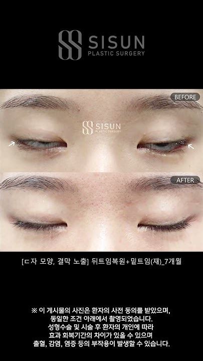 ★뒤트임복원밑트임재수술★ ㄷ자 모양 결막노출 교정 7개월 전후영상 Youtube