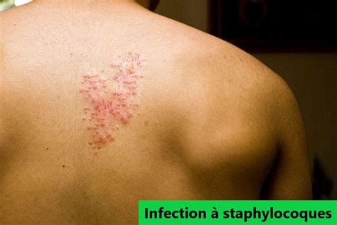 Staphylocoque Les Traitements Naturels Quil Vous Faut
