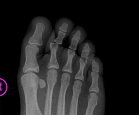 Pre Dislocation Syndrome Haro Podiatry Center