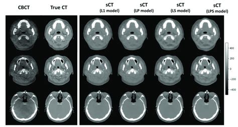 Examples Of Dl Output Images True Ct Cbct Synthetic Ctl1 Loss Download Scientific Diagram
