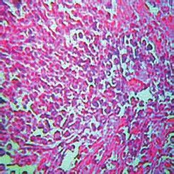 Figure1 Diffuse Infiltration Of The Testis With Intermediate Sized Download Scientific Diagram