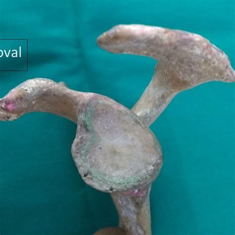 Showing Oval Shaped Glenoid Cavity Download Scientific Diagram