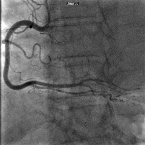 Coronary Angiogram Showing Unobstructed Rca Download Scientific Diagram