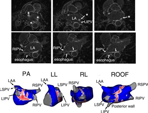 Three Month Post Ablation Mri Showing The Atrial Wall Ablation Scar Download Scientific