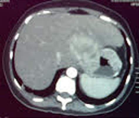 Computed Tomography Ct Which Reveals A Large Exophytic Mass In The Download Scientific