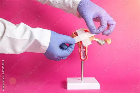 The Doctor Holds A Medical Plaster Near The Model Of The Girl S Gynecological System On A Pink