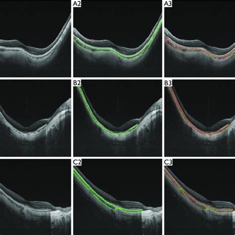 Example B Scans With Choroid Segmentation Results Overlaid The Green Download Scientific