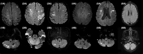 Diffusionweighed Imaging Of Stroke Secondary To Cancer Two Images A Download Scientific