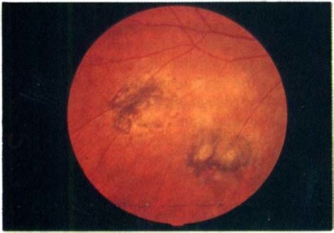 Toxoplasmic Retinochoroiditis In A Patient Who Download Scientific Diagram