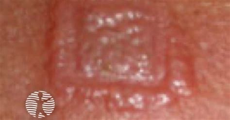 Positive Patch Test To Benzocaine Image