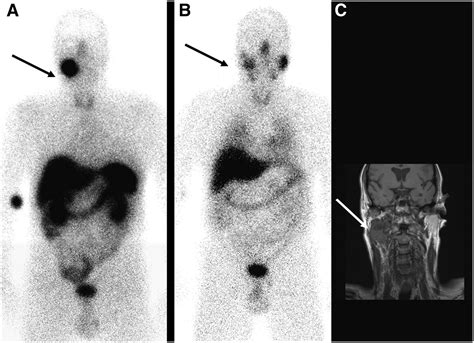 Octreotide Scan