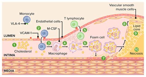 Atherosclerosis Pathogenesis Pathology Of Atherosclerosis Ping