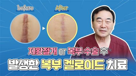 제왕절개로 인해 생긴 켈로이드ㅣ켈로이드가 사라지지 않는다면😭 Youtube
