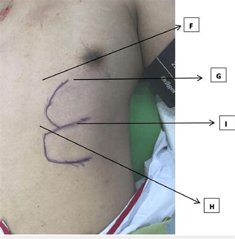 Markings To Demarcate Surgical Incision For The Chest Wall Flap F I