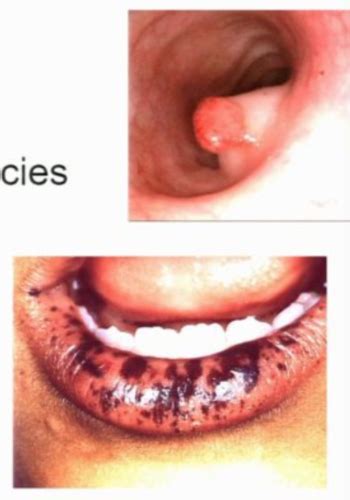 Genodermatoses Flashcards Quizlet