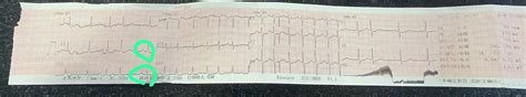 AFIB Or Not R EKGs