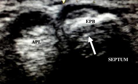 First Dorsal Compartment Of Wrist Showing One Apl And One Epb Without Download Scientific