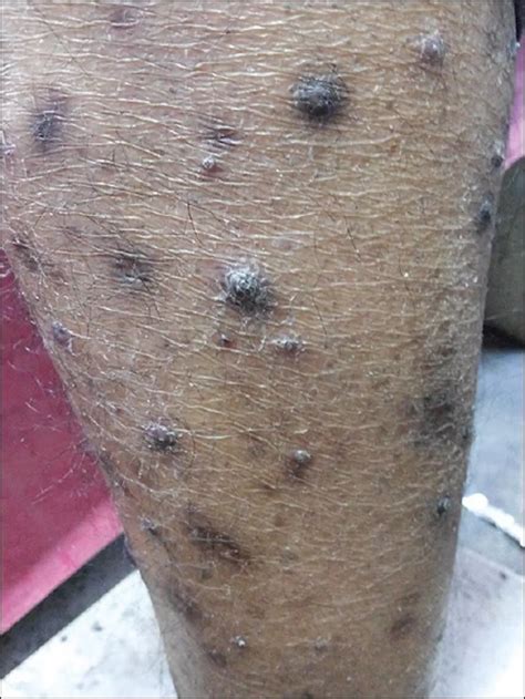 Hiv Rash What They Look Like And Their Causes Verywellhealth