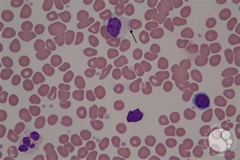 Large Granular Lymphocyte In T Lgl Leukemia