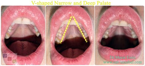 Causes Symptoms And Treatment Of High Arched Palate