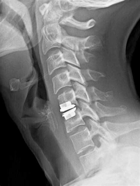 Dr Eric J Arias Md Cervical Radiculopathy