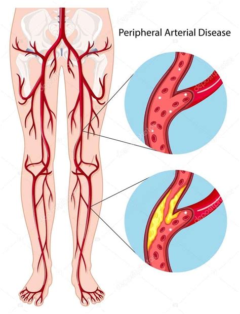 Understanding Claudication Leg Pain And Reduced Blood Flow