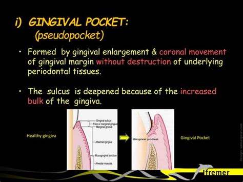 Periodontal Pockets And Its Pathogenesis Pptx