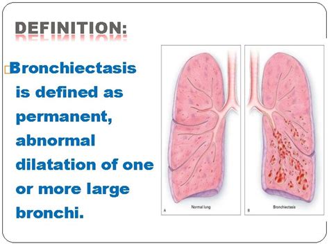 Bronchiectasis Definition Bronchiectasis Is Defined As Permanent Abnormal