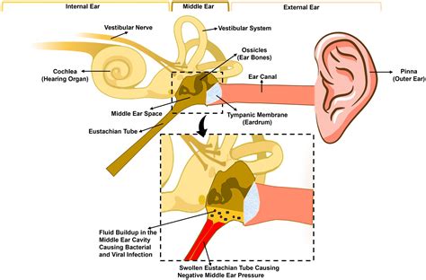 File Otitis Media  Wikem