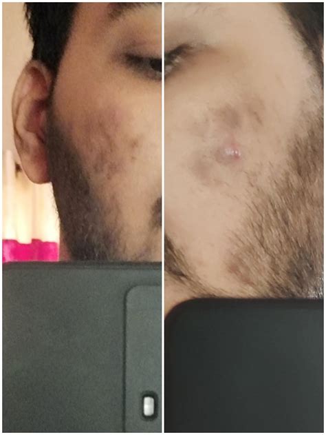 What Should I Do To Remove This It Has Been On My Face Since Months R Malegrooming