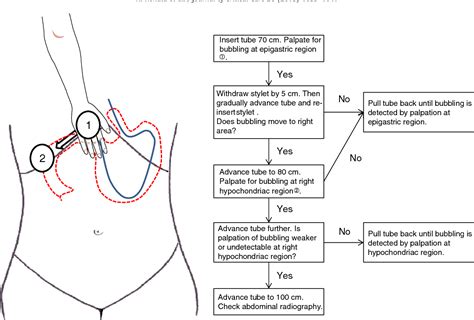 What Is The Typical Length For Post Pyloric Placement Of An Enteral