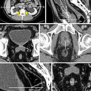 The Measurement Of CT Imaging Parameters A AB And CD Are Measured As Download Scientific