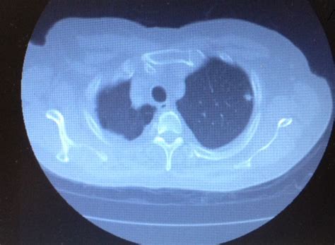 Thoracoscopic Left Apical Trisegmentectomy Ctsnet