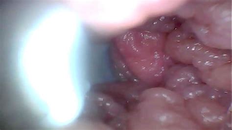 Endoscope Videos Xvideos Com
