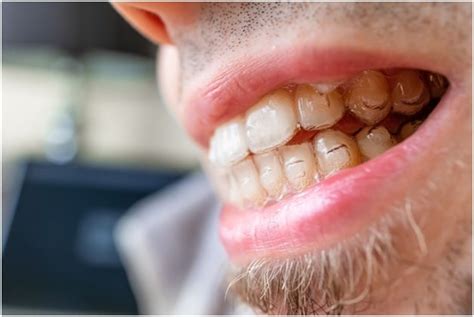 Invisalign Attachments Understanding Their Purpose And Care Invisalign Attachments Understanding Their Purpose And Care