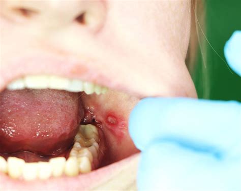Gum Infection After Tooth Extraction
