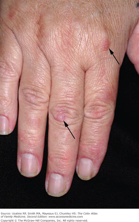Dermatomyositis Basicmedical Key