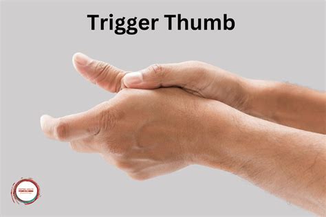 Understanding Trigger Finger And Trigger Thumb Symptoms Causes And