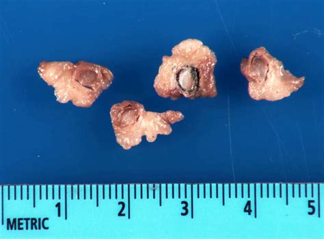 Pulmonary Embolism Gross
