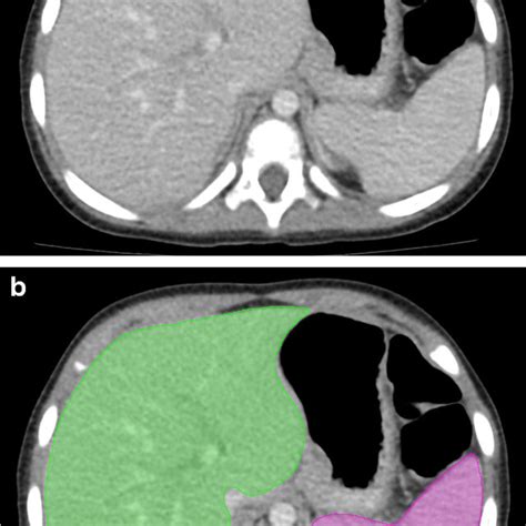 Representative Liver And Spleen Manual Segmentation In A 17 Year Old