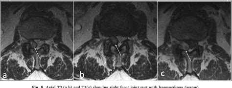 Figure 5 From Anatomy And Pathology Of Facet Joint Semantic Scholar