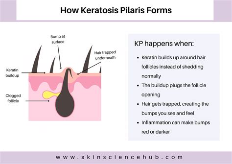 How To Treat Keratosis Pilaris Chicken Skin