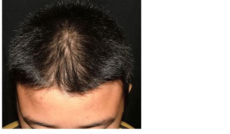 A Patch Of Hair Thinning On The Frontal Area Of The Scalp Without Scale Download Scientific