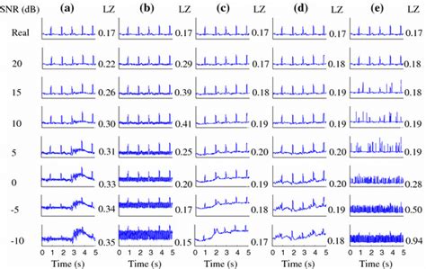 Real Ecg Signals And These Signals Plus Various Types Of Noise At Download Scientific Diagram