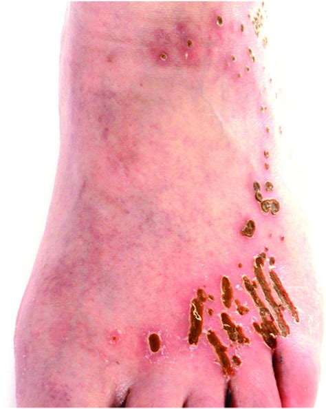 Perforating Folliculitis Face