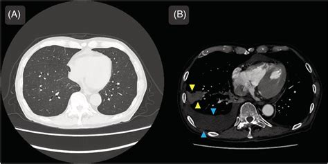 Imaging Findings A Chest CT Shows Bilateral Diffuse Groundglass Download Scientific Diagram