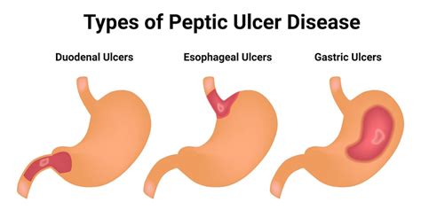 Premium Vector Types Of Peptic Ulcer Disease Duodenal Ulcers Esophageal Ulcers Gastric Ulcers
