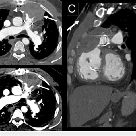 Ct Pulmonary Angiogram Of The Chest Showing The Mediastinal Abscess
