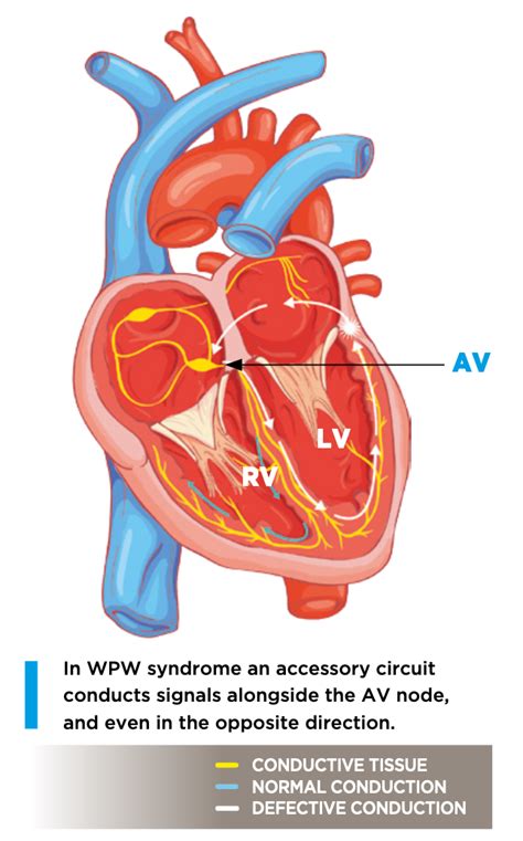 Cape Town AF Centre New ESC Guidelines On SVT Management Catheter Ablation Is Key